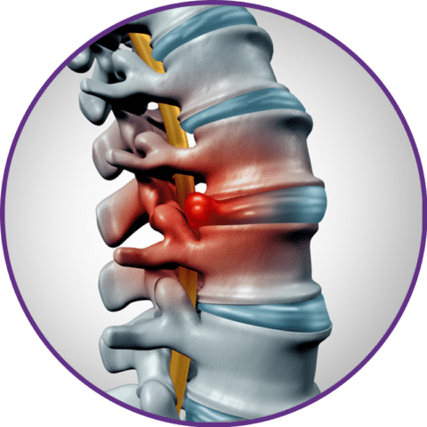 Decompression Therapy | Syracuse Medical | Live a Pain Free Life